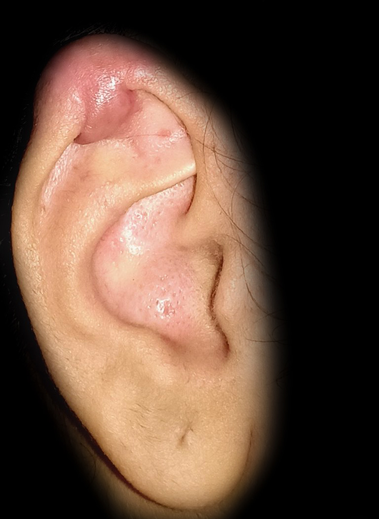 Keloid Surgery for Khathija | LaunchGood